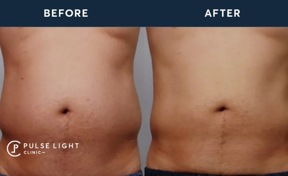 HIFU Body Skin Tightening | Pulse Light Clinic London