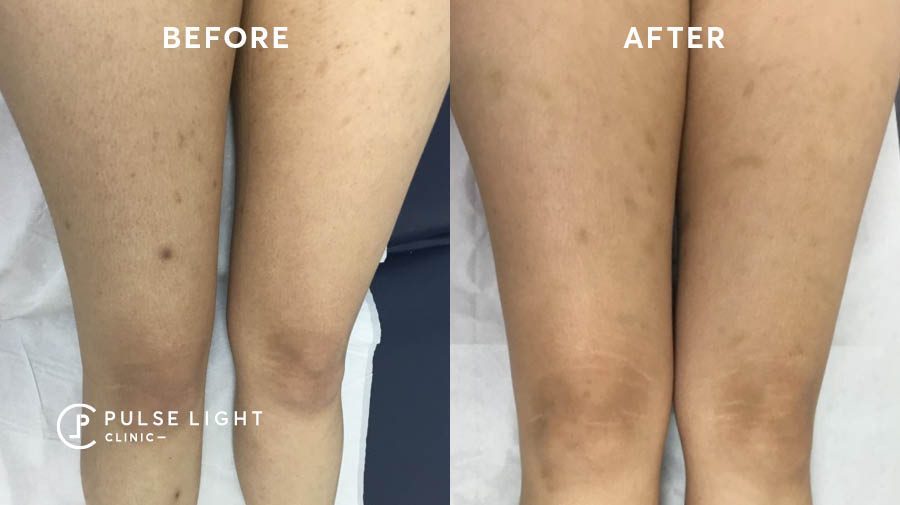 Laser Hair Removal Legs Before And After Laser Hair Removal Legs Before And After