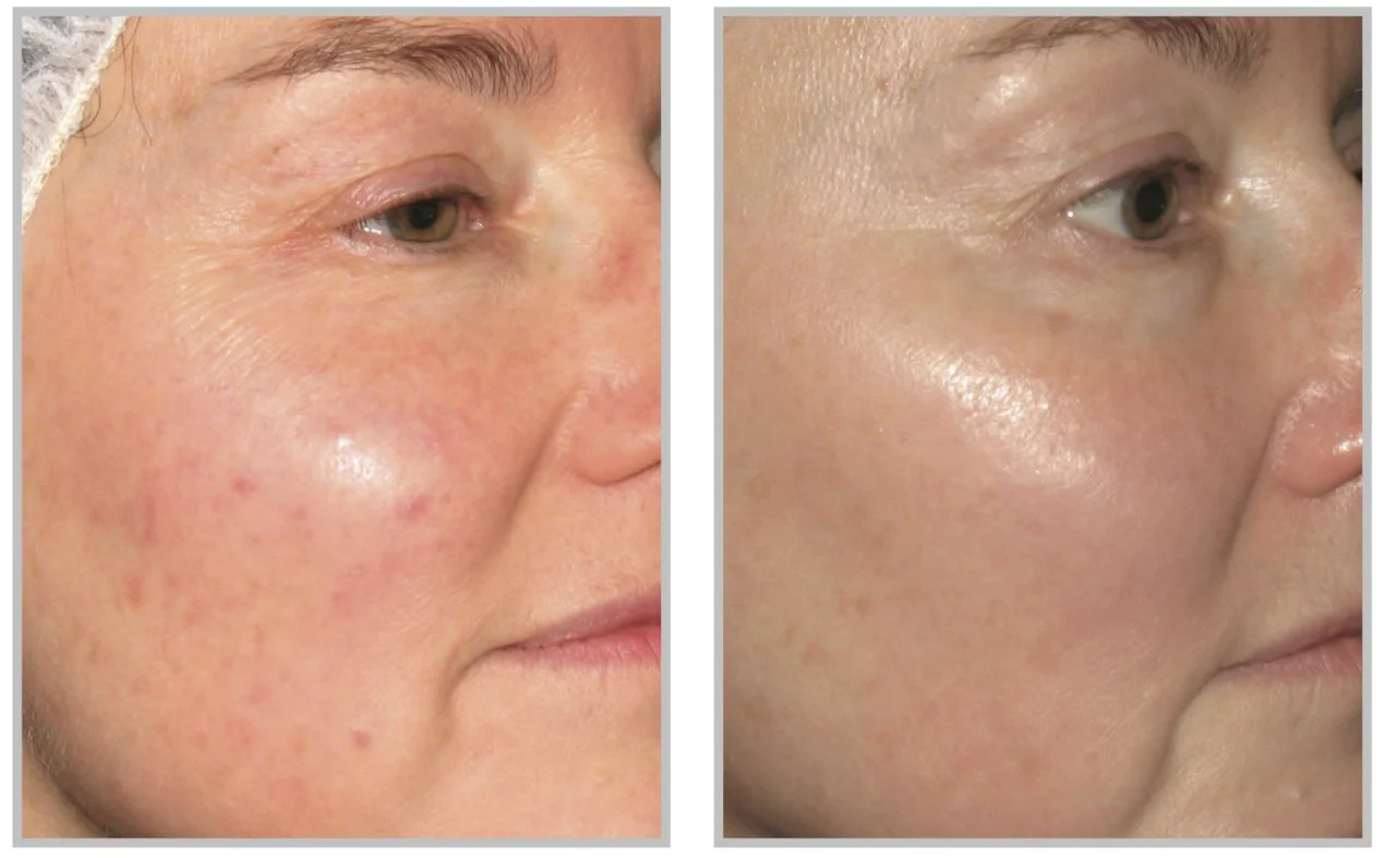 BBL Before and After Laser Real Results Pulse Light Clinic London