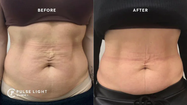 Morpheus8 Treatment Before And After Pulse Light Clinic London