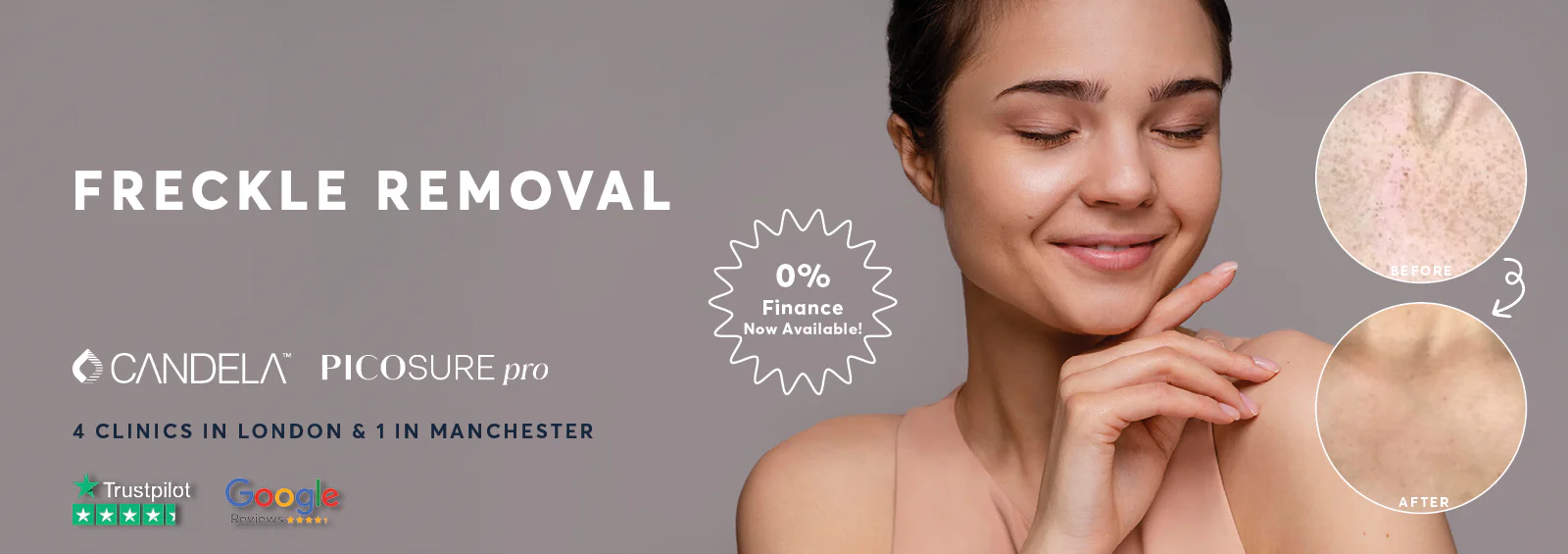 Freckle Removal London | Pulse Light Clinic London