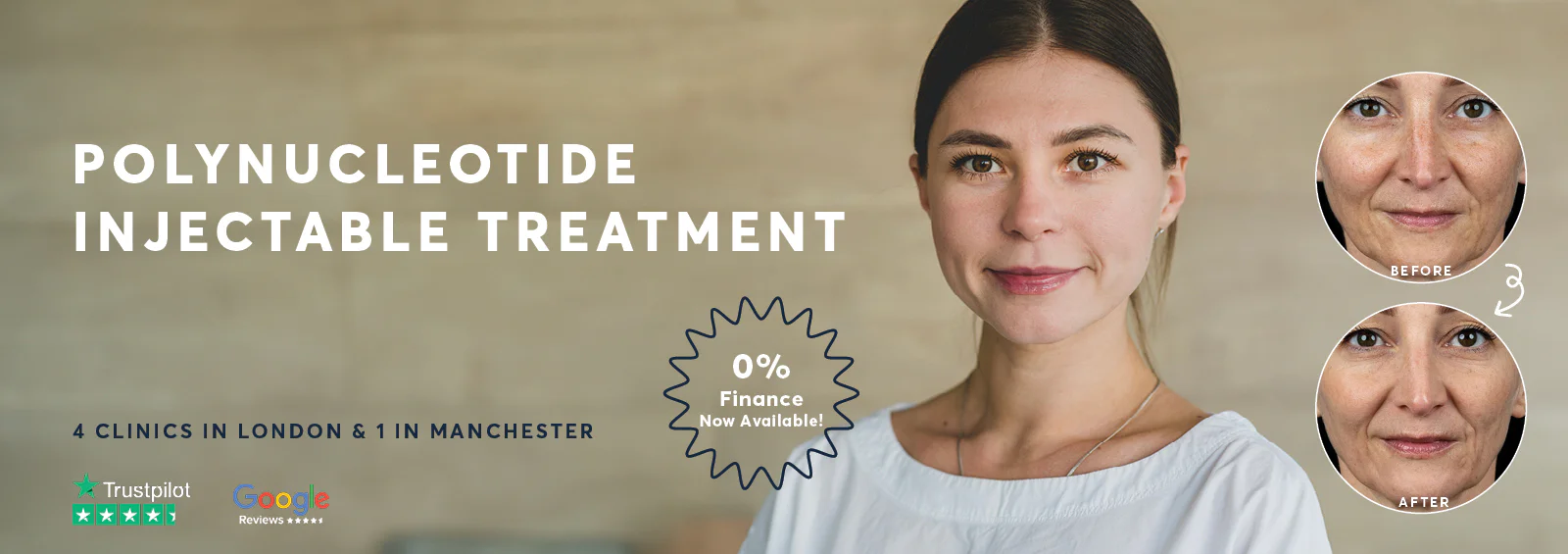 Polynucleotide Treatment | Pulse Light Clinic London