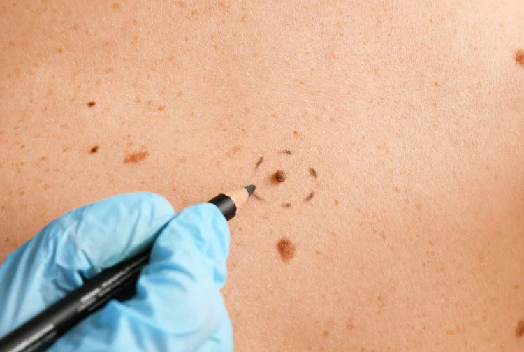 Why Do Moles Grow Hairs?: Hairy Moles and Safe Treatments